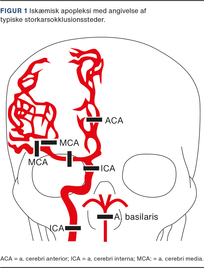 Mekanisk trombektomi ved iskæmisk apopleksi og storkarsokklusion ...