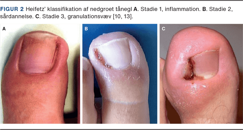 Nedgroet tånegl | Ugeskriftet.dk