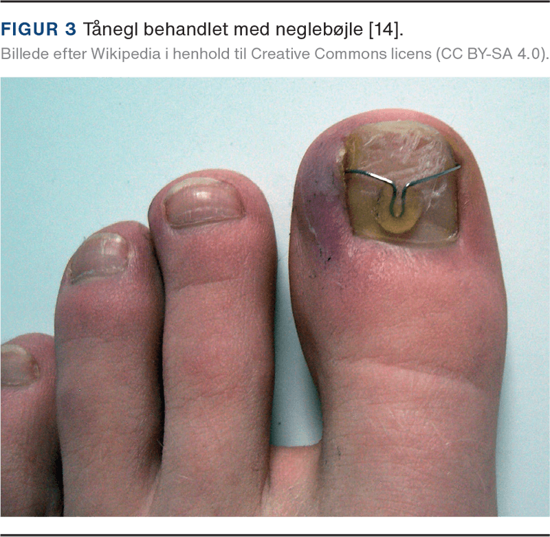 Nedgroet tånegl | Ugeskriftet.dk