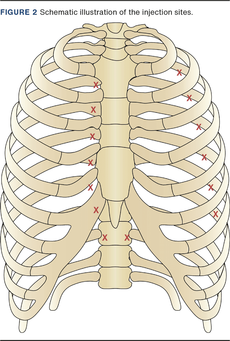 Perioperative anaesthesia by local infiltration following median ...