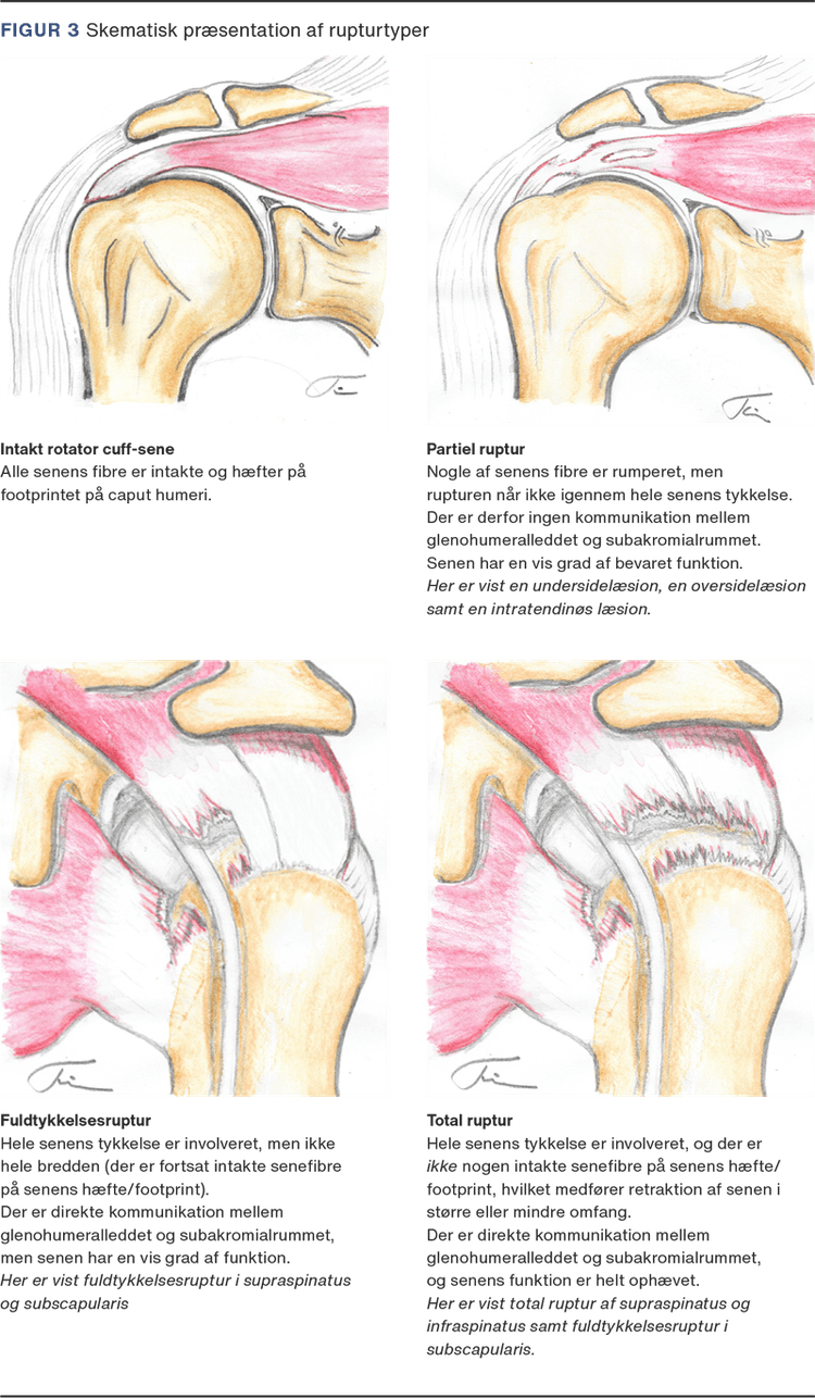 Rotator cuff-ruptur | Ugeskriftet.dk