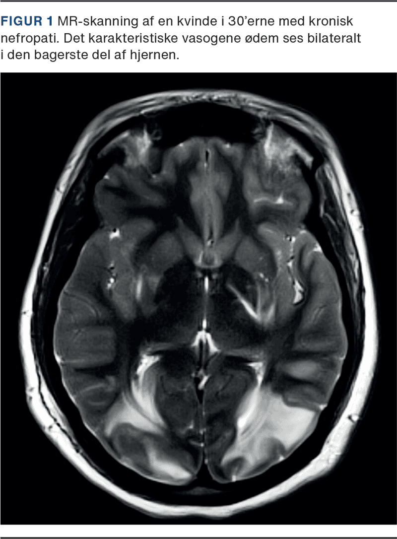 Posteriort reversibelt encefalopatisyndrom | Ugeskriftet.dk