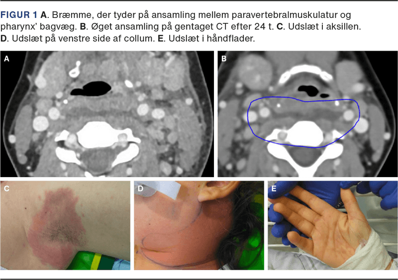 Streptokok toksisk shock-syndrom hos en rask kvinde | Ugeskriftet.dk