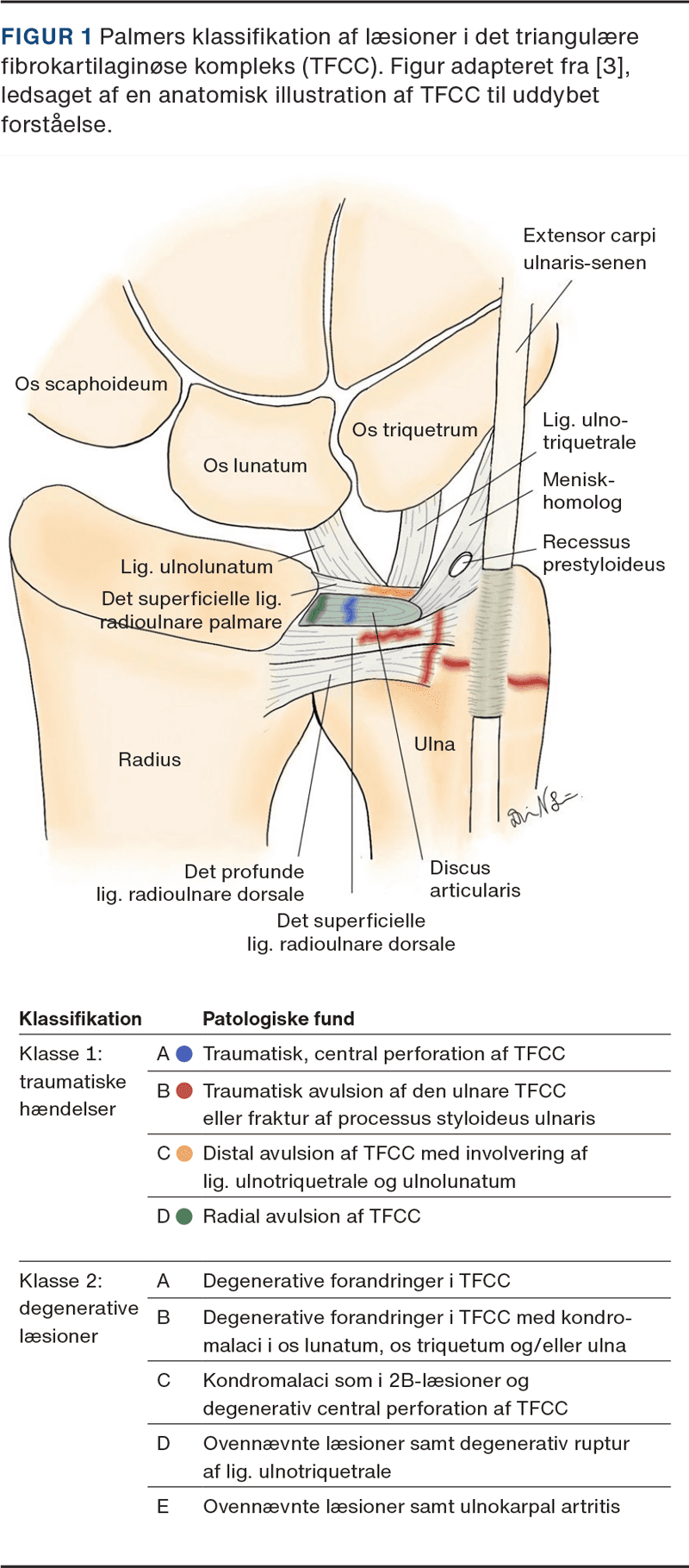 MR-skanning af læsioner i det triangulære fibrokartilaginøse kompleks | Ugeskriftet.dk