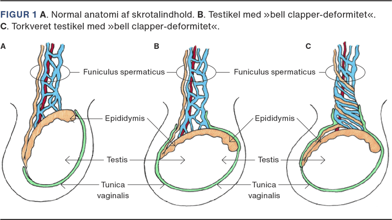 Bilateral torsio testis med unilaterale symptomer | Ugeskriftet.dk