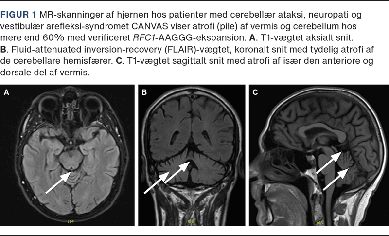 Cerebellær ataksi, neuropati og vestibulær arefleksi-syndrom (CANVAS) | Ugeskriftet.dk