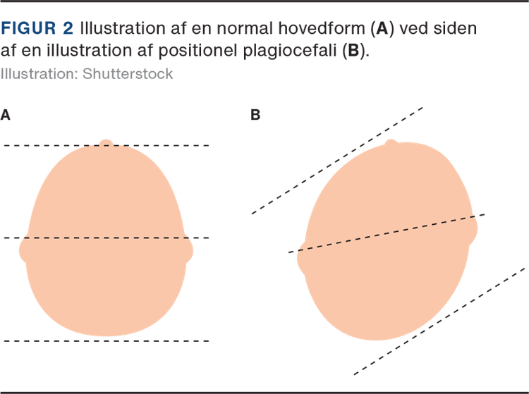 Kraniosynostose | Ugeskriftet.dk