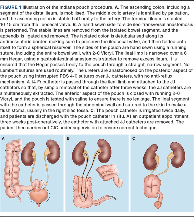 Long-term complications and functionality after continent cutaneous ...