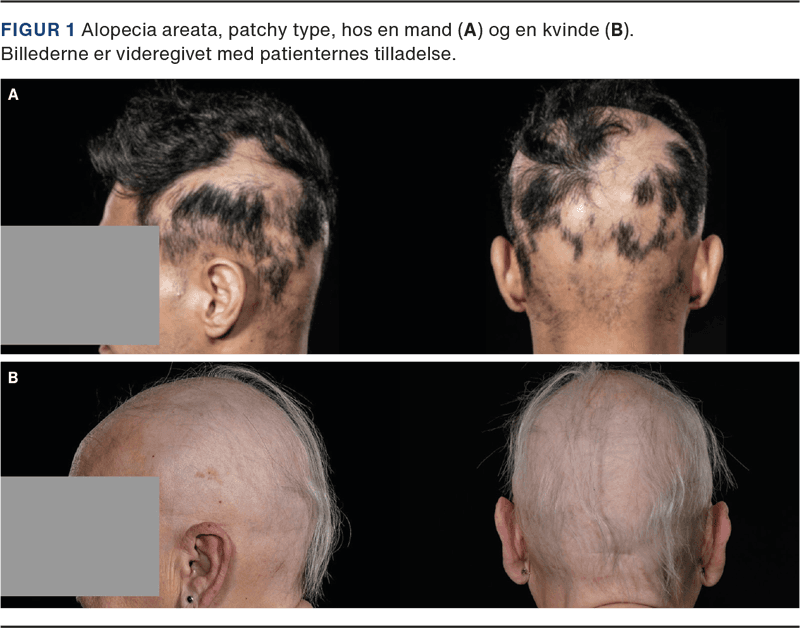 Alopecia areata | Ugeskriftet.dk