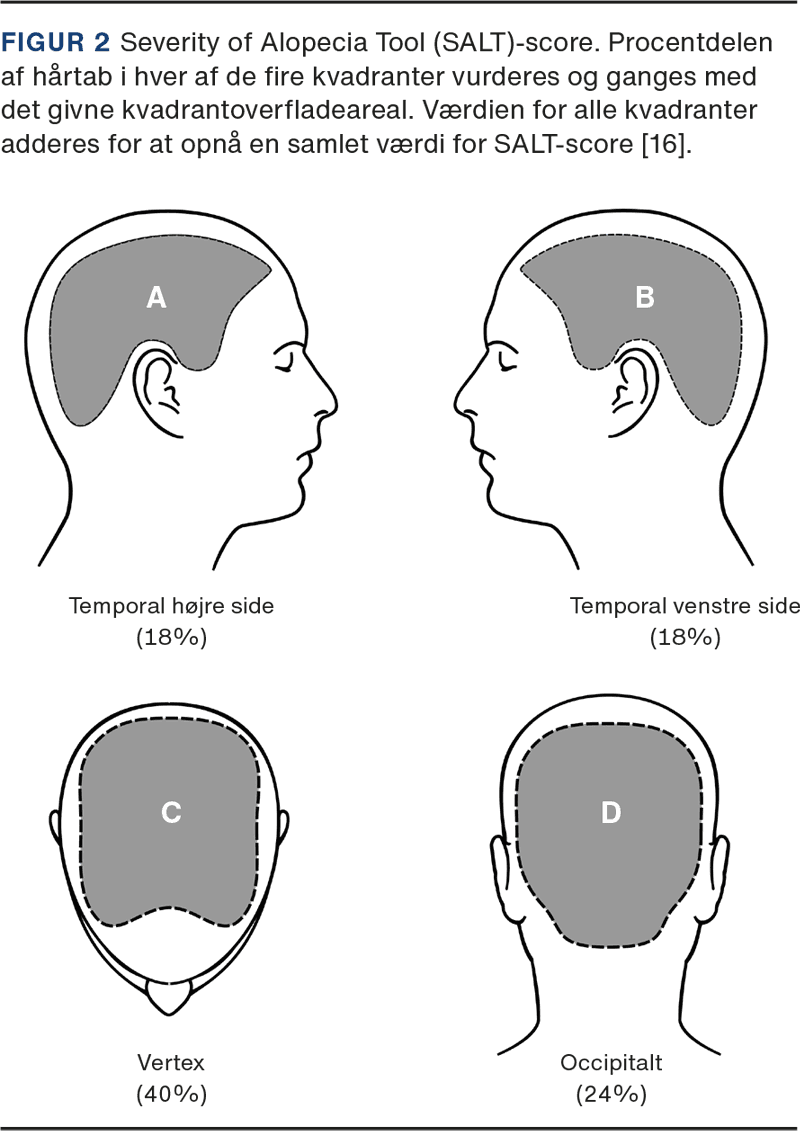 Alopecia areata | Ugeskriftet.dk