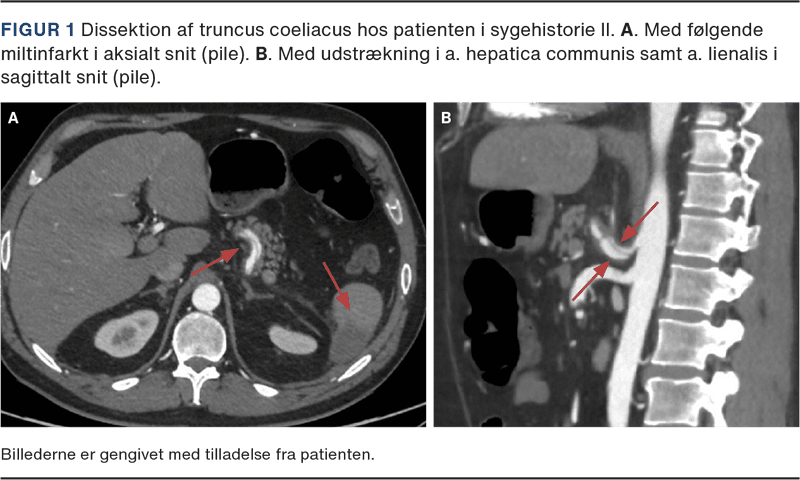 Dissektion af truncus coeliacus | Ugeskriftet.dk
