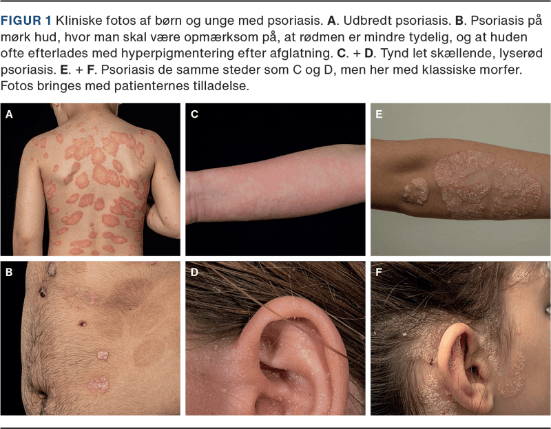 Psoriasis hos børn og unge | Ugeskriftet.dk