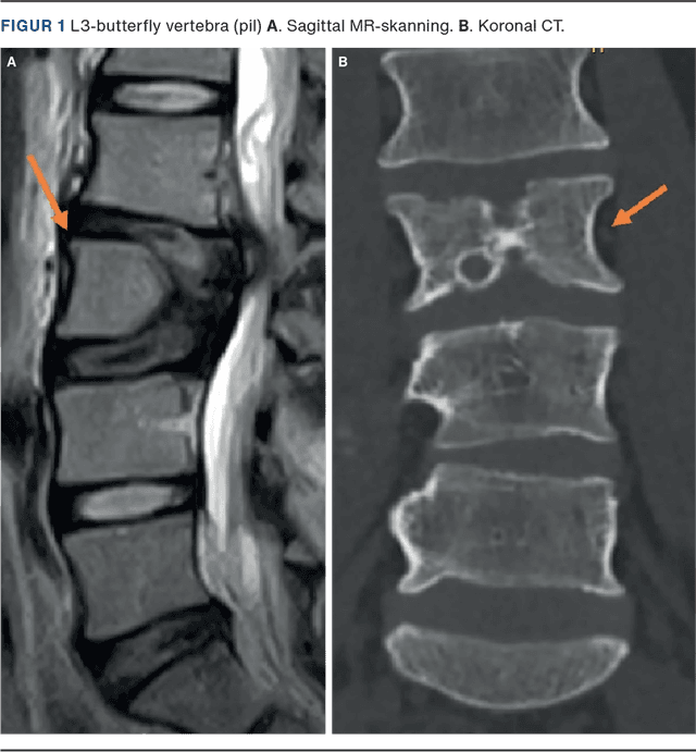 Discusprolaps i forbindelse med butterfly vertebra-anomali | Ugeskriftet.dk