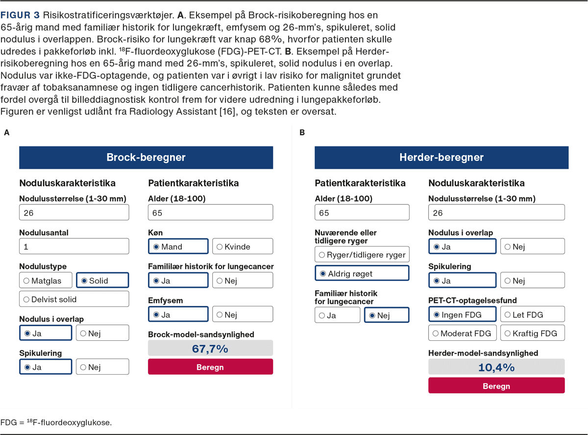 Håndtering af tilfældige noduli i lungerne ved CT | Ugeskriftet.dk