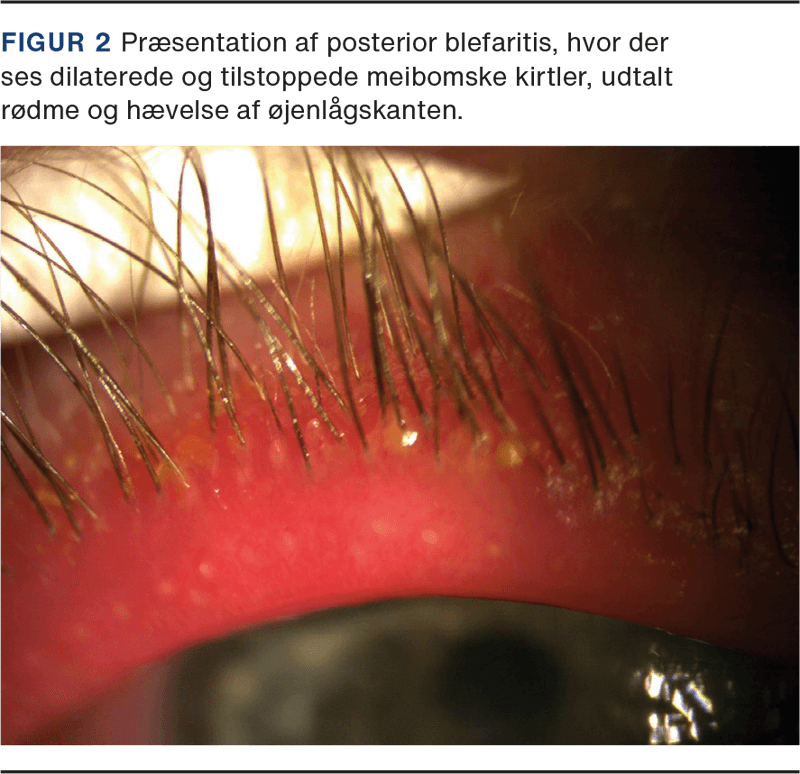 Blefaritis | Ugeskriftet.dk