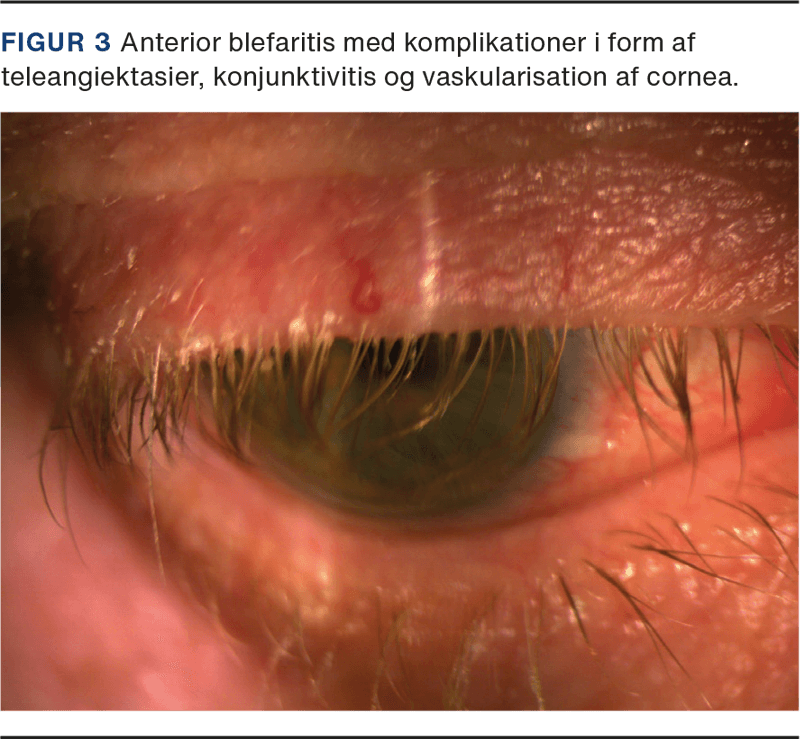 Blefaritis | Ugeskriftet.dk