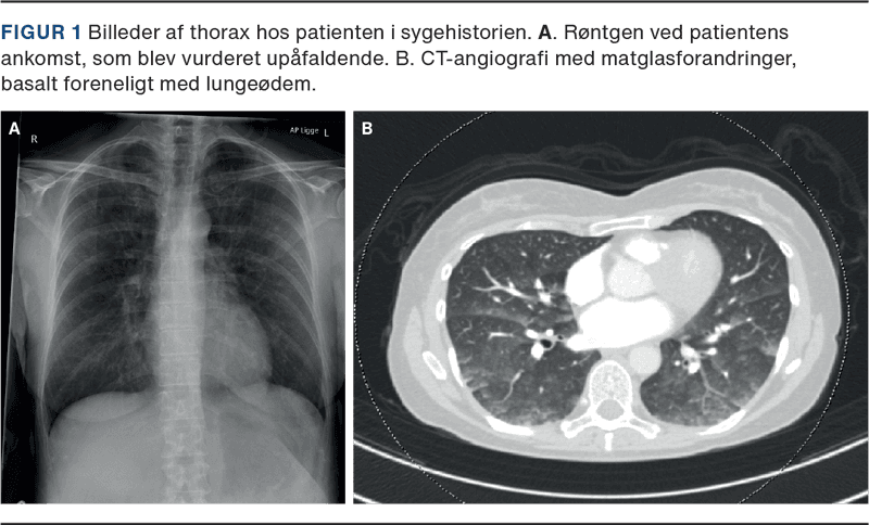Svømmeinduceret lungeødem | Ugeskriftet.dk