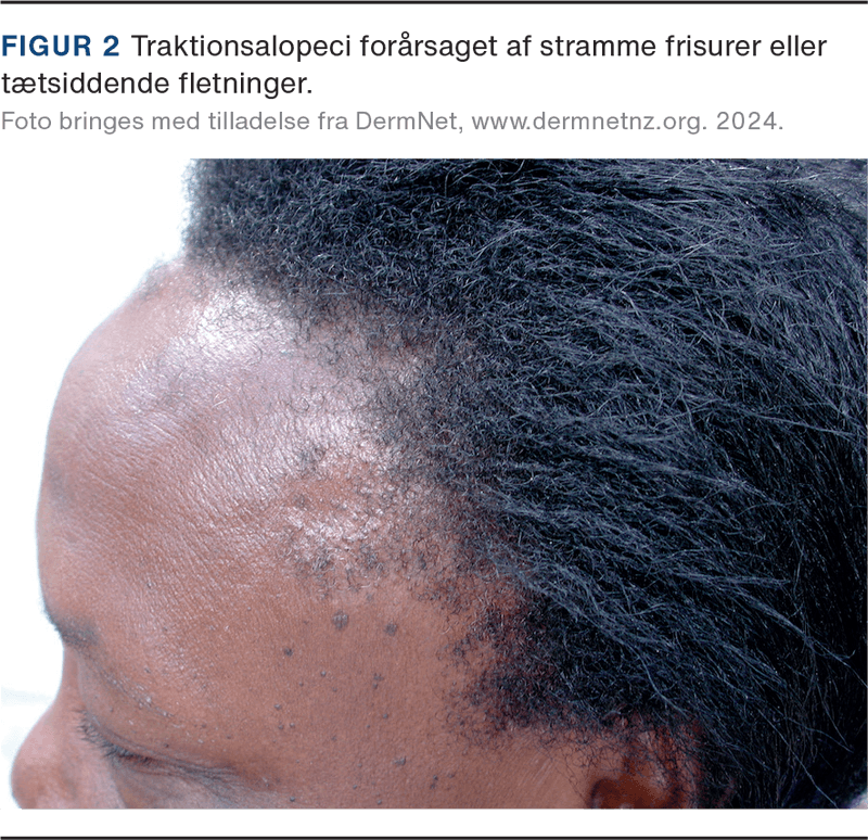 Dermatologiske sygdomme hos personer med mørkpigmenteret hud ...
