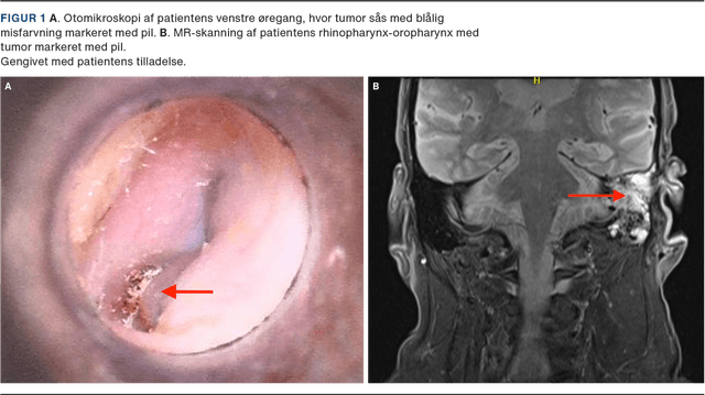 Malign tumor fra ceruminøs kirtel i ydre øregang | Ugeskriftet.dk