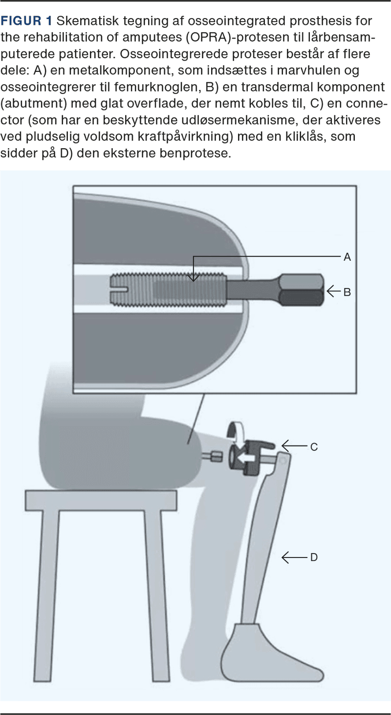 Osseointegrerede proteser til femuramputerede patienter | Ugeskriftet.dk
