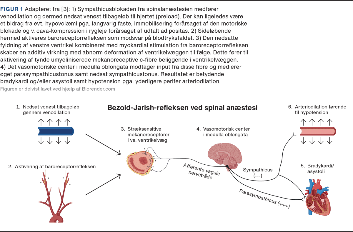 Bradykardi og asystoli under spinalanæstesi på grund af Bezold-Jarisch ...