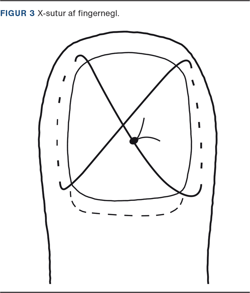 Akutte fingerspidsskader og negleskader på hånden | Ugeskriftet.dk