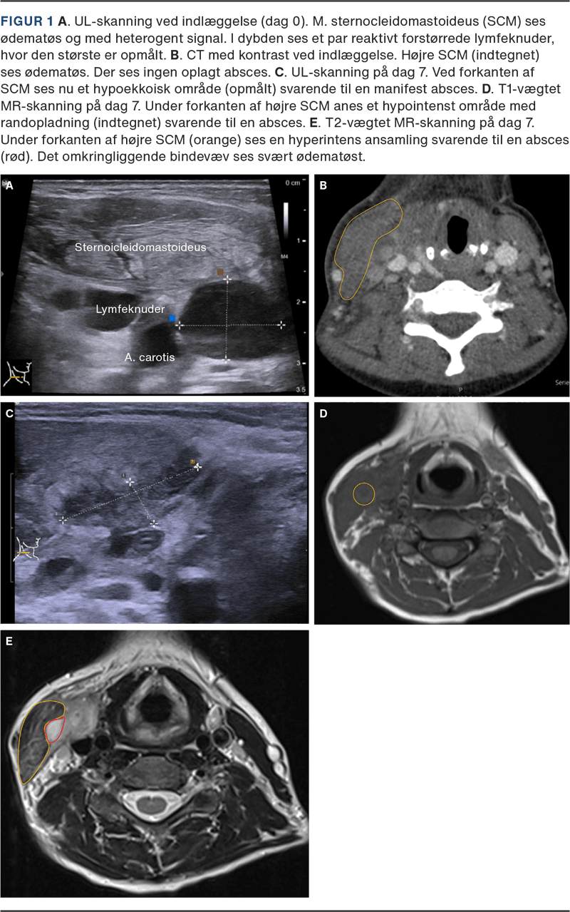 Pyomyositis i m. sternocleidomastoideus | Ugeskriftet.dk