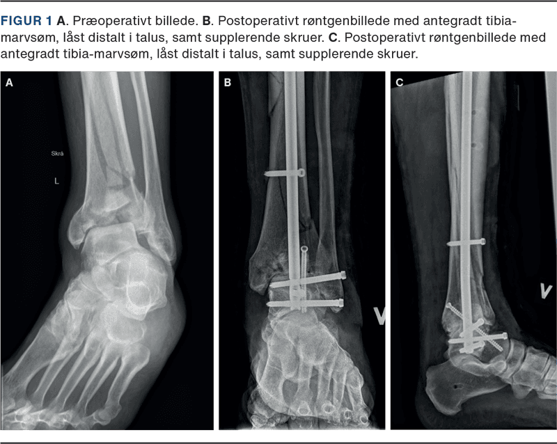 Artrodese af talokruralleddet med antegradt tibia-marvsøm | Ugeskriftet.dk