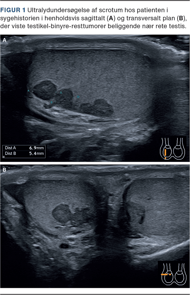 Testikeltumorer ved adrenogenitalt syndrom | Ugeskriftet.dk