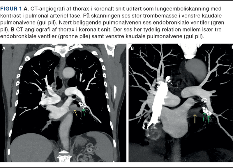 Pulmonal venetrombose hos patient med endobronkiale ventiler ...