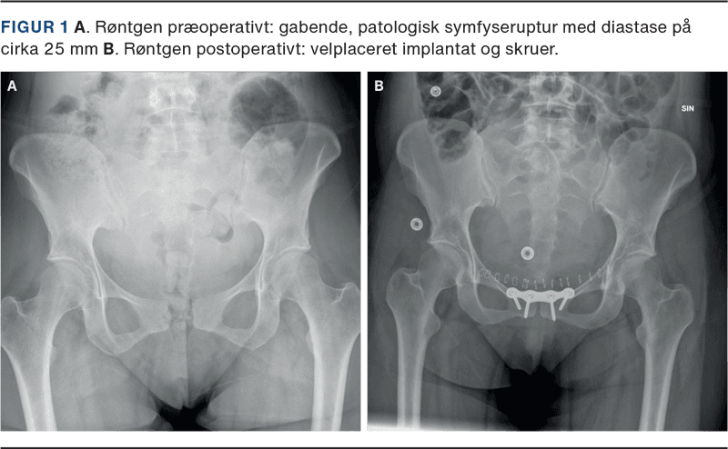 Peripartum symfysiolyse med behov for kirurgisk intervention ...