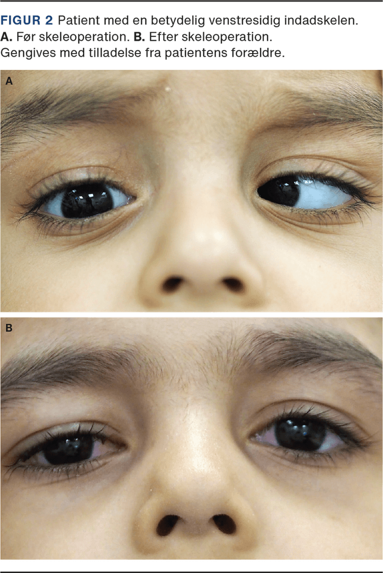 Skelekirurgi afhjælper funktionsmæssige og psykosociale problemer ...