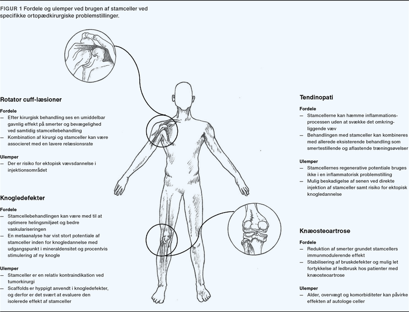 Behandling med stamceller i ortopædkirurgien | Ugeskriftet.dk