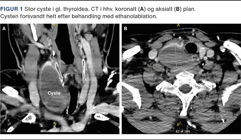 Diagnostik og behandling af cyster på halsen | Ugeskriftet.dk