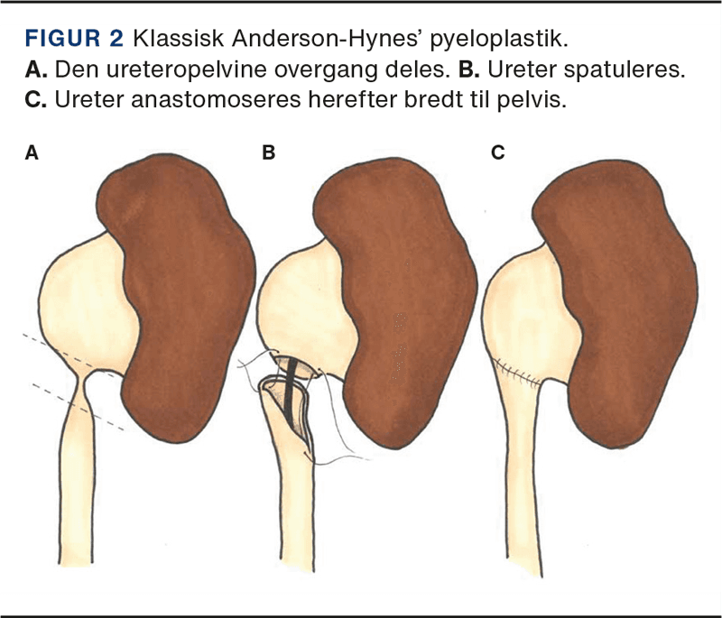 Rekonstruktiv urologi | Ugeskriftet.dk
