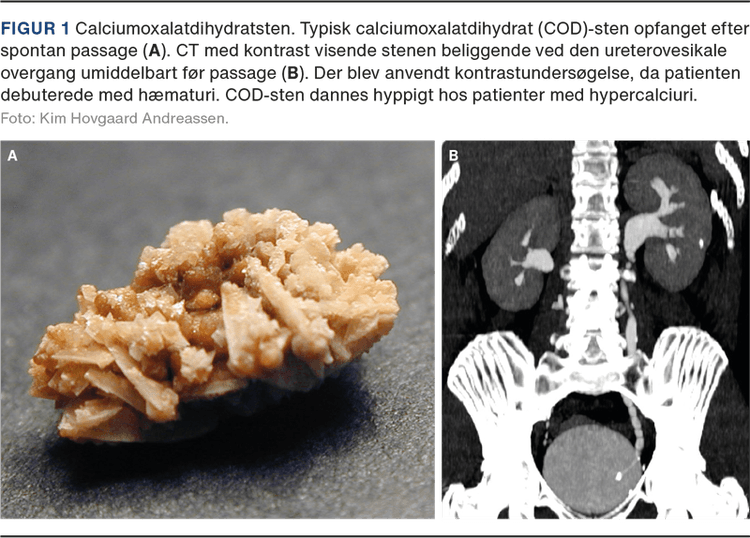 Nyresten | Ugeskriftet.dk