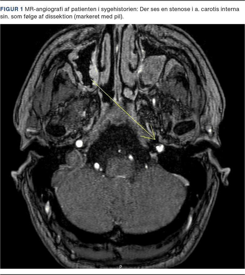 N. hypoglossus-parese ved a. carotis interna-dissektion | Ugeskriftet.dk
