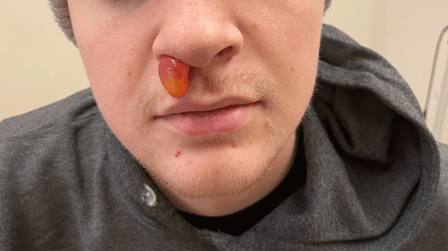 Antrochoanal polyp | Ugeskriftet.dk