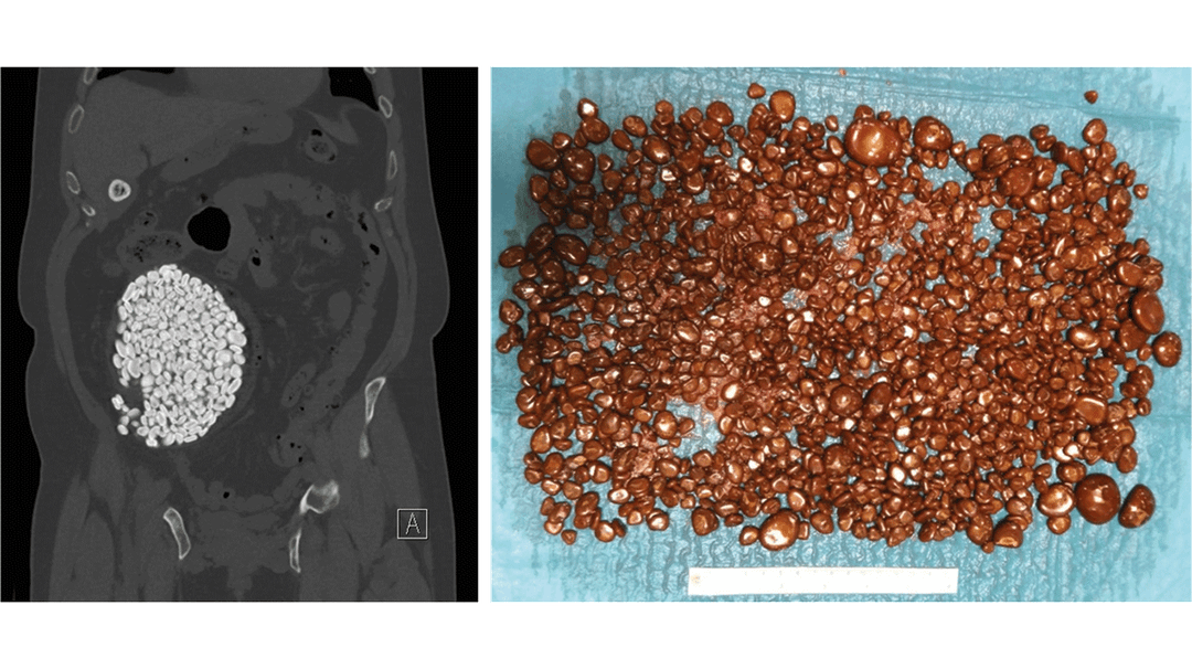 Stenudtamponeret Indiana pouch | Ugeskriftet.dk