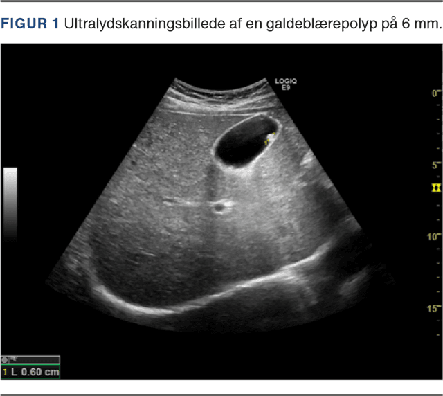 Opfølgningsprogrammer ved galdeblærepolypper | Ugeskriftet.dk