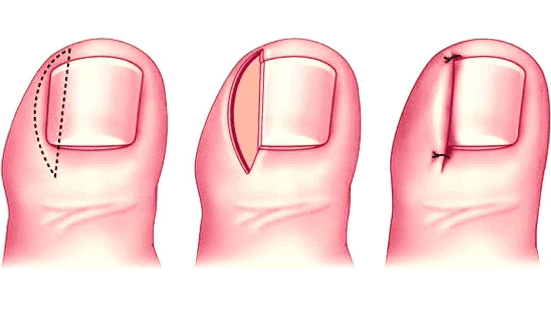 Nedgroet tånegl | Ugeskriftet.dk