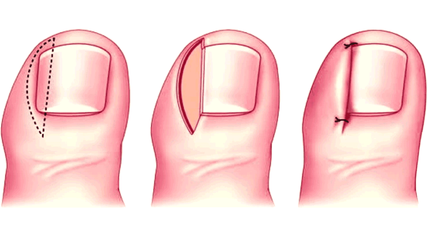 Nedgroet tånegl | Ugeskriftet.dk