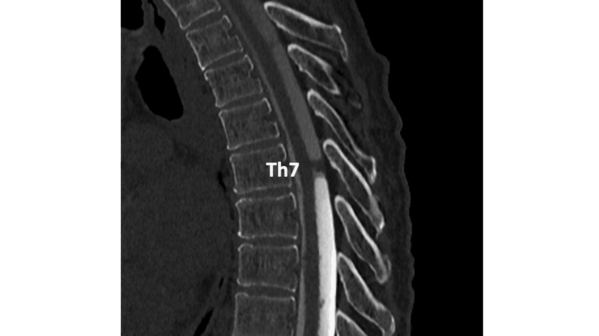 Infratentoriel superficiel siderosis | Ugeskriftet.dk