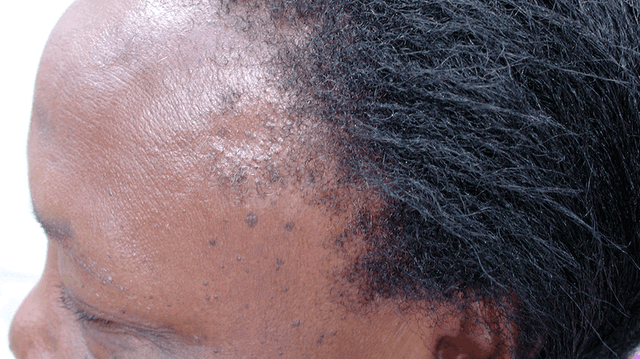 Dermatologiske sygdomme hos personer med mørkpigmenteret hud ...