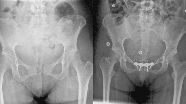Peripartum symfysiolyse med behov for kirurgisk intervention ...