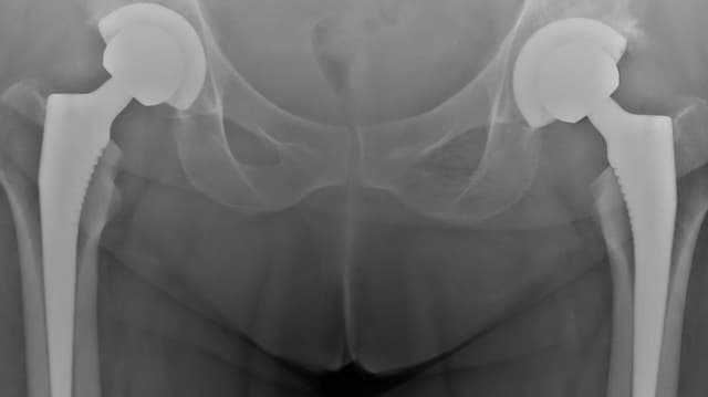 Bilateral atraumatisk caput femoris-osteonekrose hos rask 45-årig ...