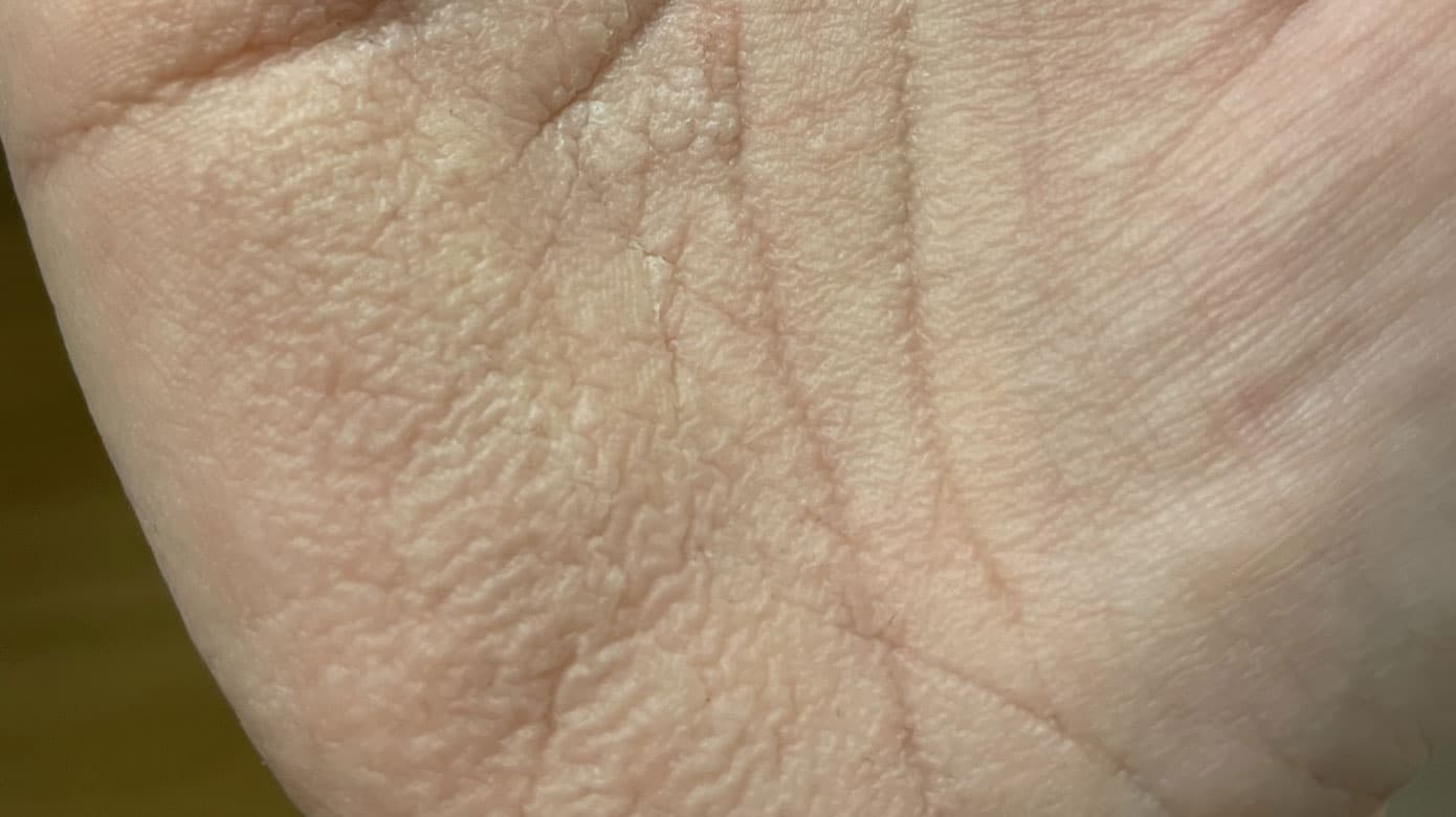 Aquagenic wrinkling of the palms | Ugeskriftet.dk