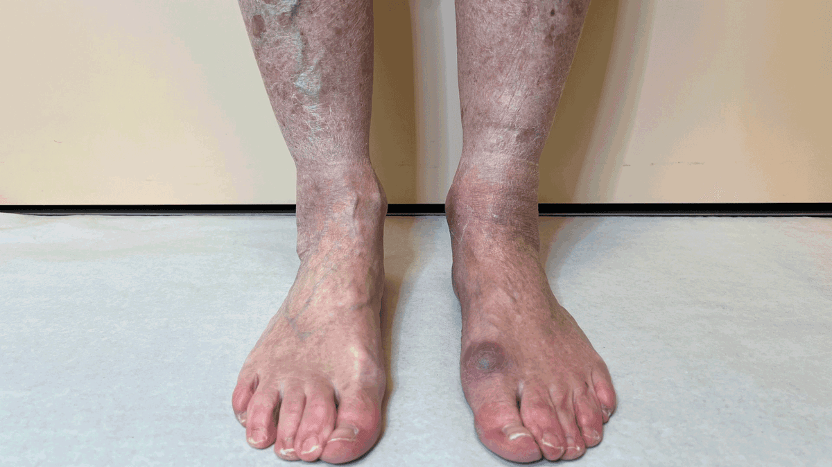 Acrodermatitis chronica atrophicans | Ugeskriftet.dk