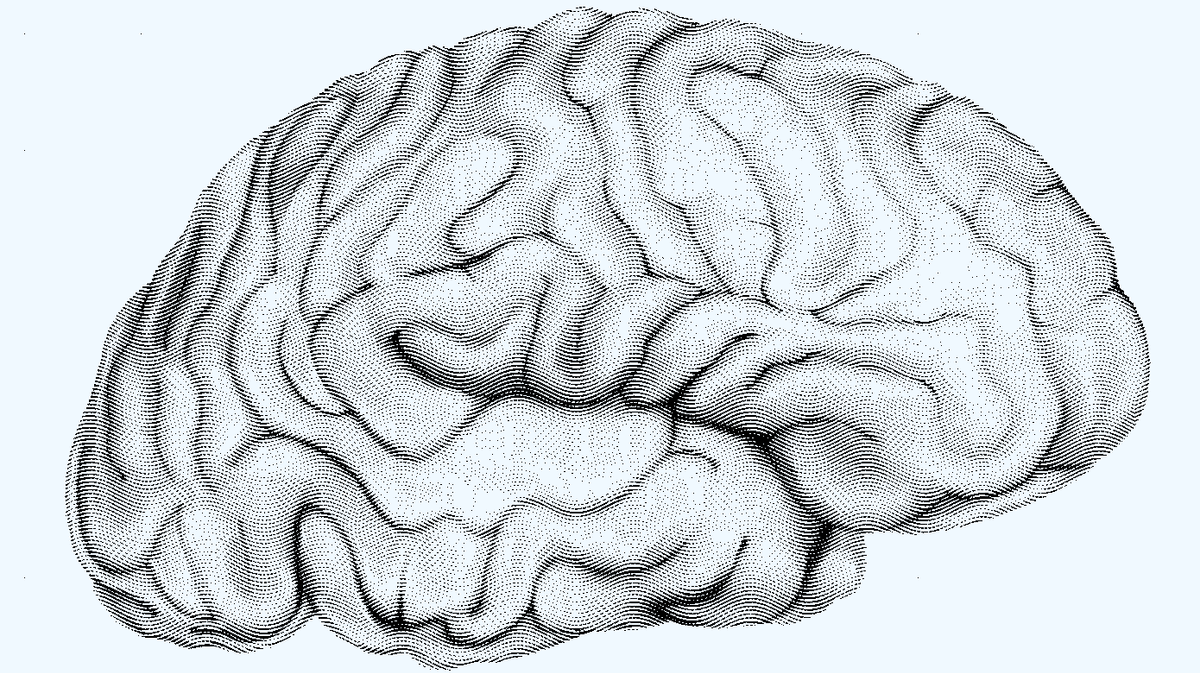 Funktionel venstresidig hemiparese | Ugeskriftet.dk