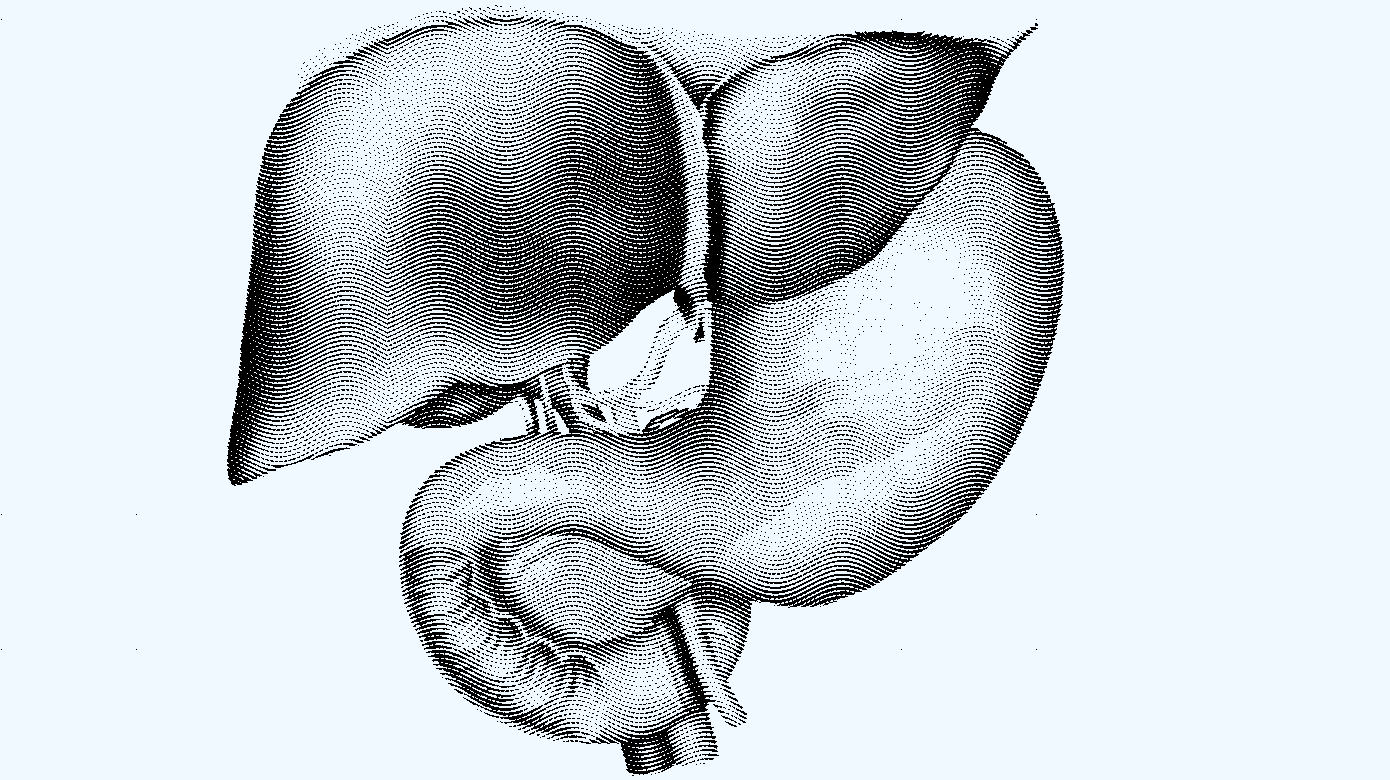Risikovurdering af steatotisk leversygdom uden brug af biopsi ...